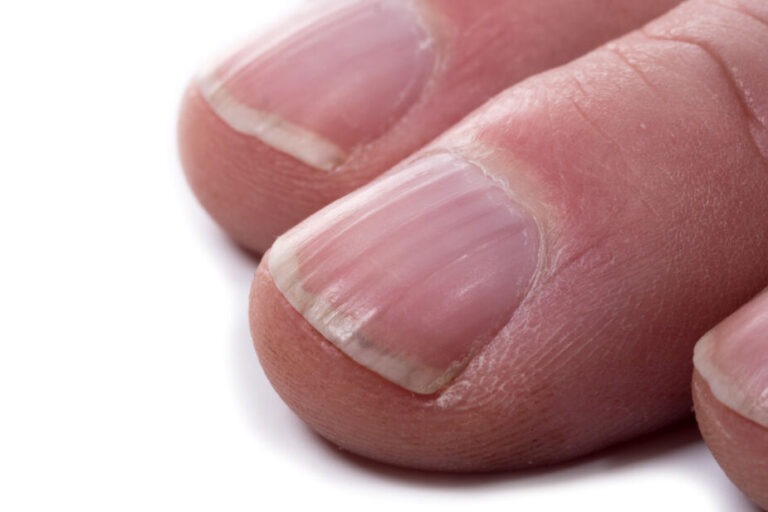 Fingernails : A Window To Gut Health - Nail Changes In Gluten ...