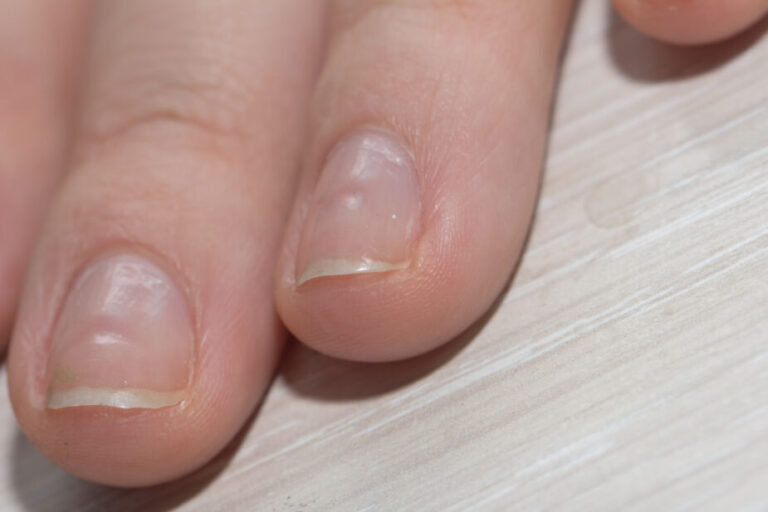 Fingernails : A Window To Gut Health - Nail Changes In Gluten ...